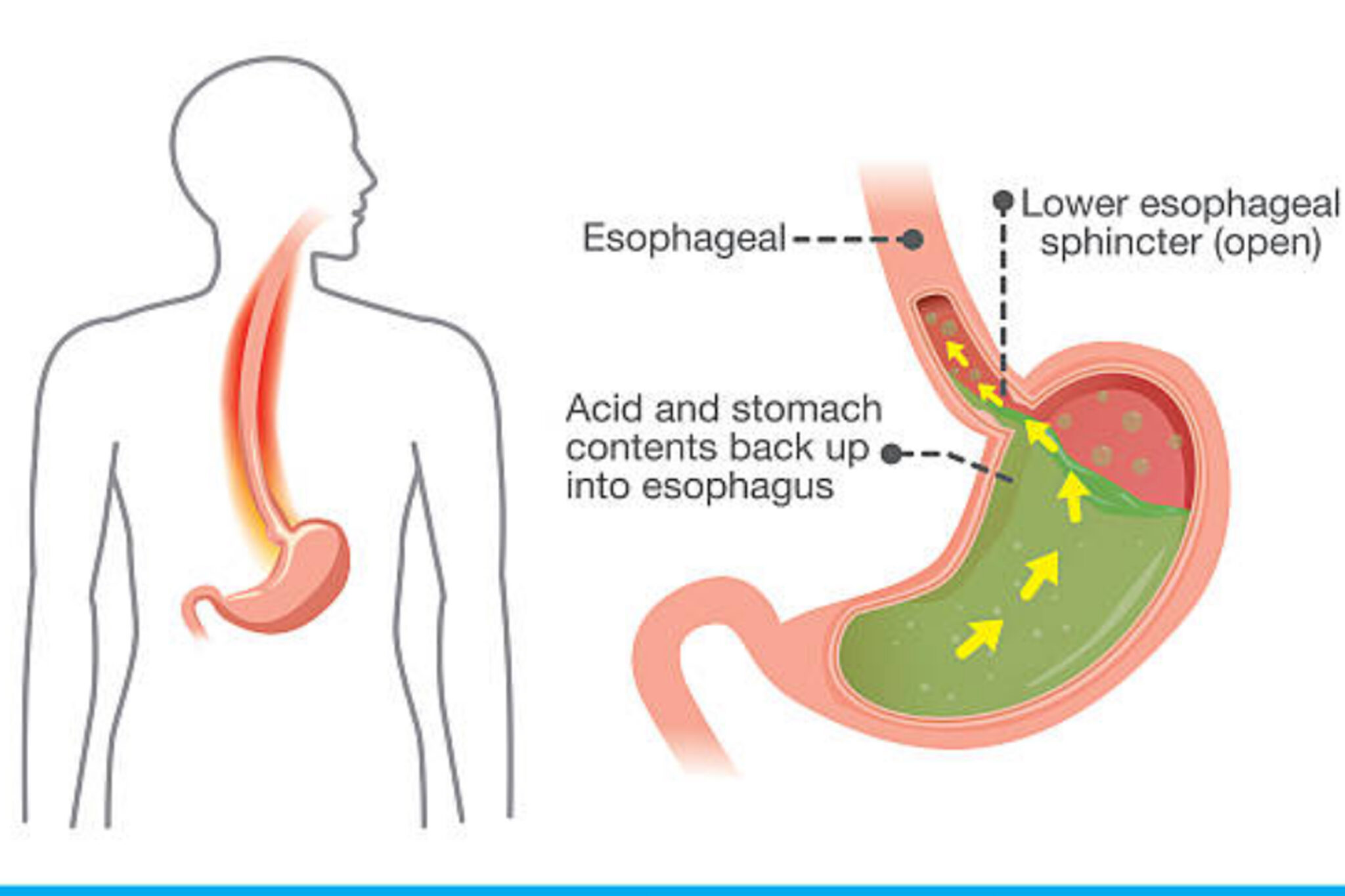 Acid Reflux Treatment Dubai | Gerd Specialist In Dubai - Dr Balaji